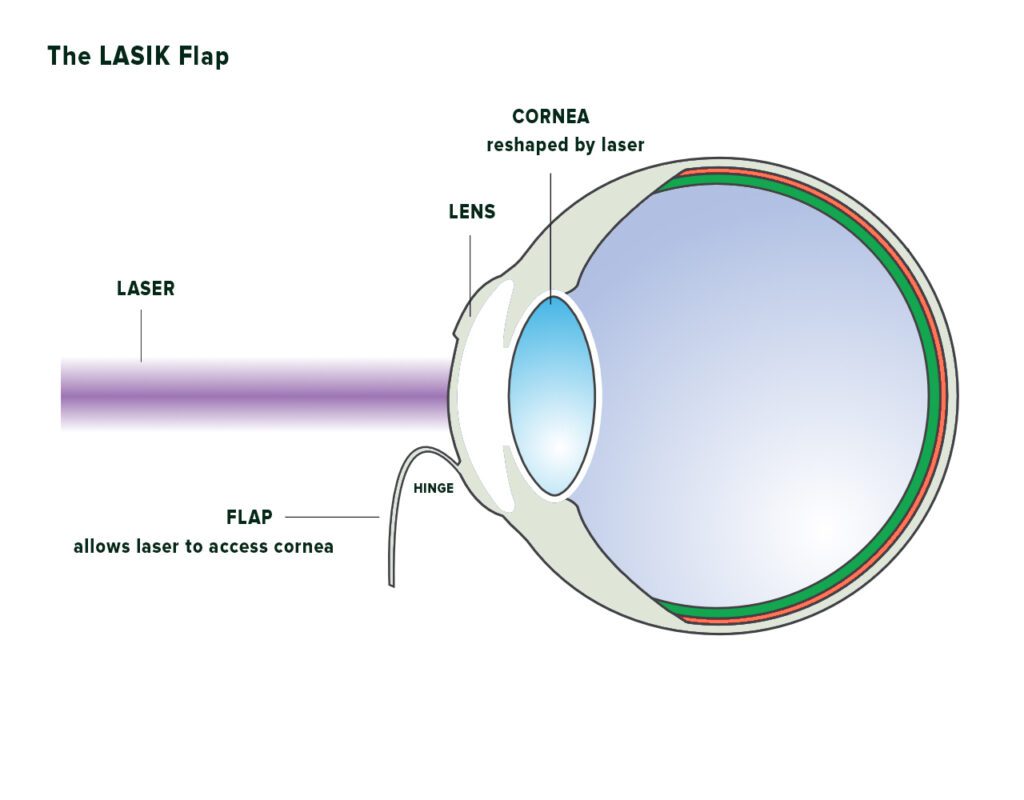 The LASIK Flap: Your Questions Answered